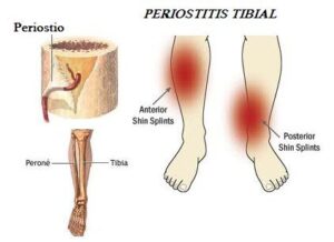 Periostitis de la tibia - En Pucol