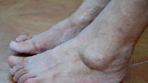 Sinovitis de tobillo - En Pucol